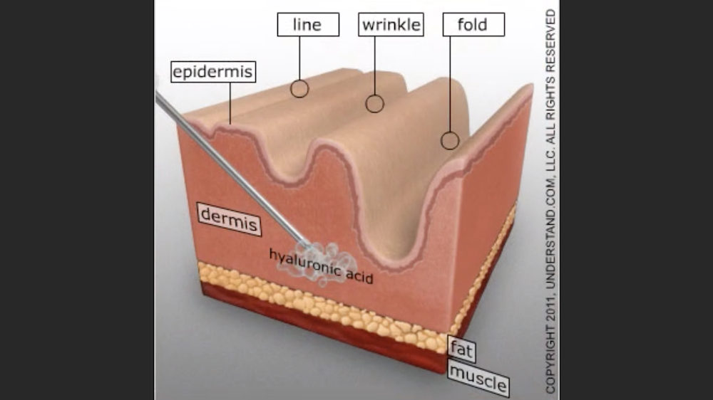 Lip and Facial Volume Options at Renew Medispa